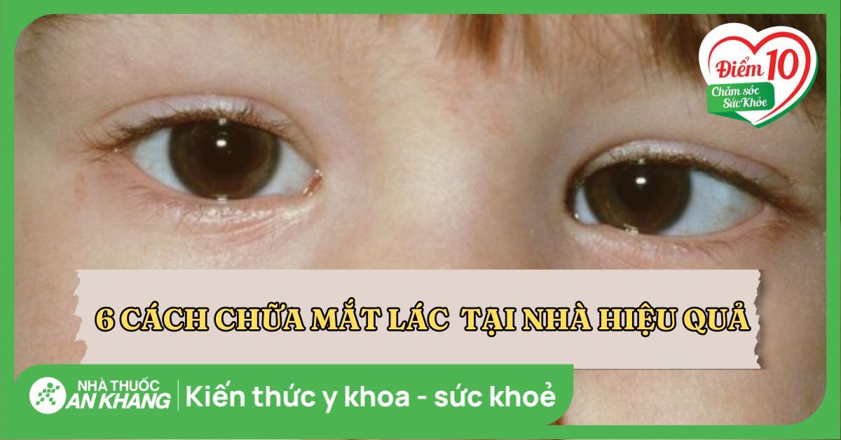 Bật mí 6 cách chữa mắt lác tại nhà đơn giản, hiệu quả