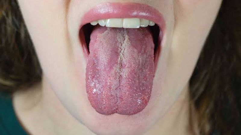 Nhiễm nấm Candida: Nguyên nhân, dấu hiệu và cách điều trị